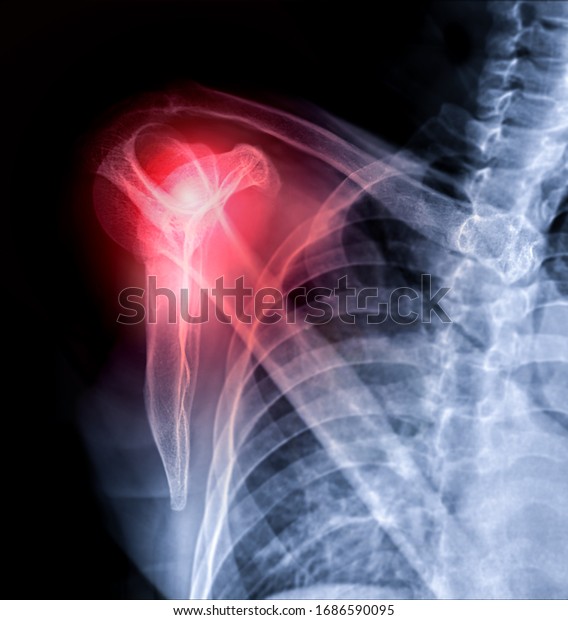 Xray Shoulder Joint Transcapular View Diagnosis Stock Photo 1686590095 ...