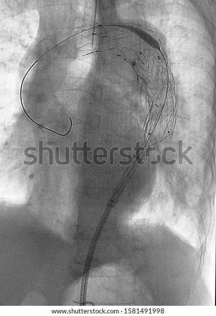 Xray Showed Tevar Procedure Involves Placement Stock Photo 1581491998 ...