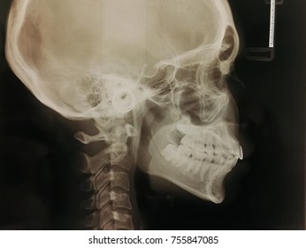 Xray Skull Cervical Teeth Normal Alignment Stock Photo 755847085 ...
