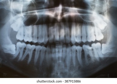 Panoramic Dental Xray Human Teeth Stock Photo (Edit Now) 244320940
