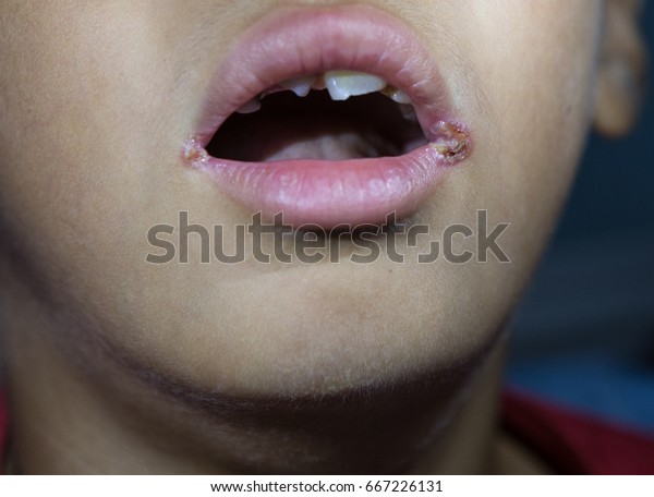 Стоковая фотография 667226131: Zooming Closeup View Angular Stomatitis ...