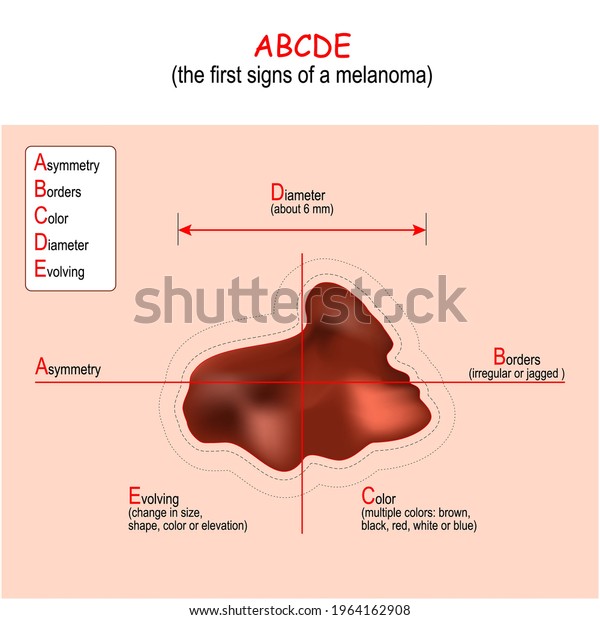 Abcde Rule Early Detection Melanoma Signs: เวกเตอร์สต็อก (ปลอดค่า ...