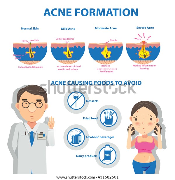 Acne formation Info Graphic and diagrams.Vector illustrations