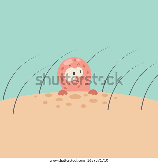 Acne On Skin Vector Illustration Pimple Stock Vector (Royalty Free ...