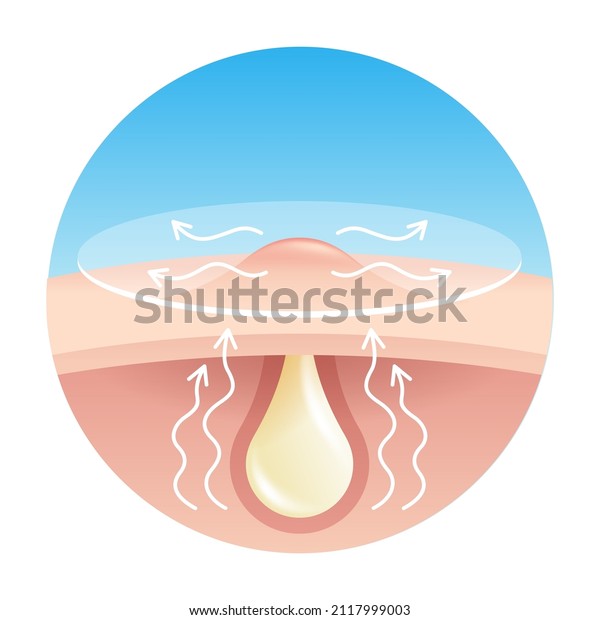 811 imágenes de Pimple patches - Imágenes, fotos y vectores de stock ...