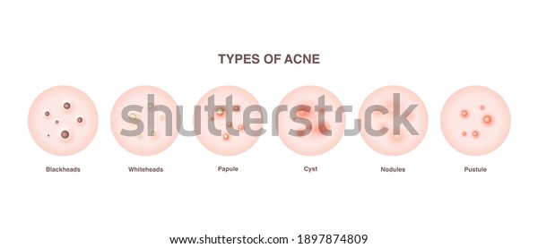 Acne Types Skin Pimples Blackheads Face Stock Vector (Royalty Free ...