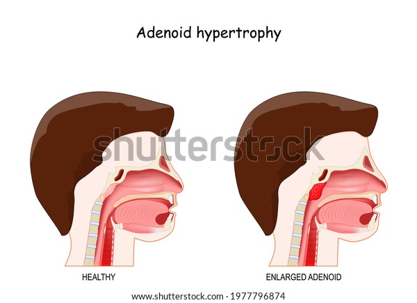 Adenoid Hypertrophy Cross Section Humans Head 스톡 벡터(로열티 프리) 1977796874 ...