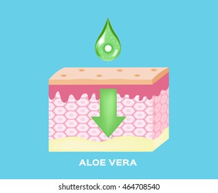 Hyaluronic Acid Filler Injection Infographic Stock Vector (Royalty Free ...