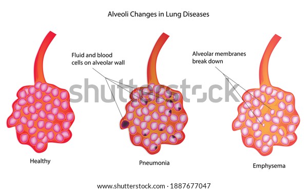 alveoli changes in lung diseases, Smoking and emphysema, alveolar ...