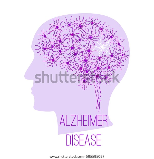 Alzheimer Disease Concept Human Brain Neurons Stock Vector (Royalty ...