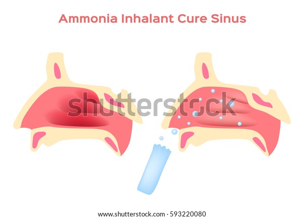 Ammonia Inhalant Cure Nasal Cavity Stock Vector (Royalty Free ...