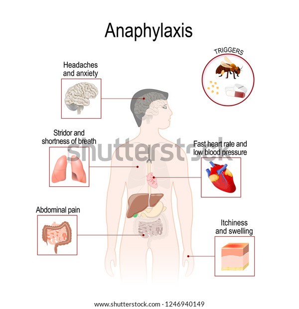 Anaphylaxis Serious Allergic Reaction That May Stock Vector (Royalty ...