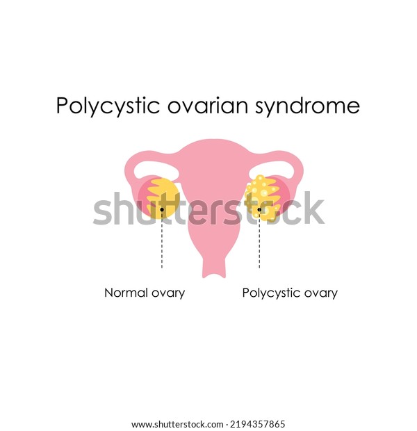 Anatomical Drawing Example Healthy Ovary Ovary: เวกเตอร์สต็อก (ปลอดค่า ...