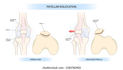Anatomy Knee Bone Fracture Dislocated Caused Stock Vector (Royalty Free ...