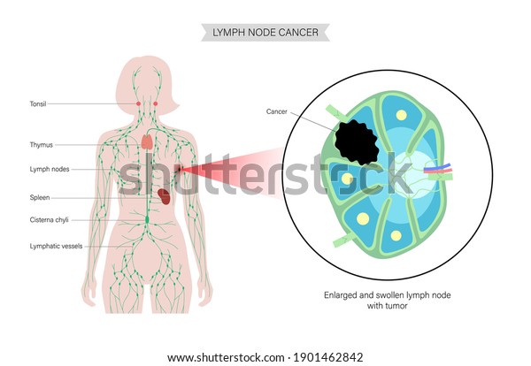 Anatomía de nódulos linfáticos con células tumorales en la silueta de ...