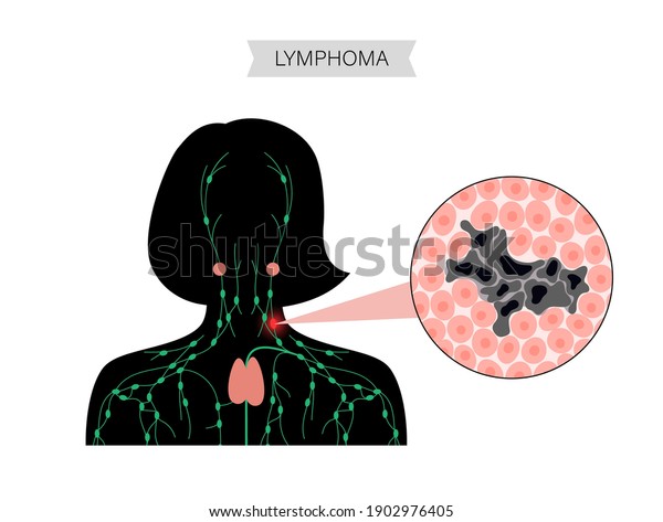 Anatomy Lymph Node Tumor Cells Woman Stock Vector (Royalty Free) 1902976405