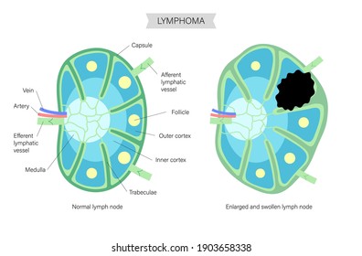 Anatomy Normal Lymph Node Cancer Lymphoma Stock Vector (Royalty Free ...