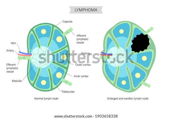 Anatomy Normal Lymph Node Cancer Lymphoma Stock Vector (Royalty Free ...