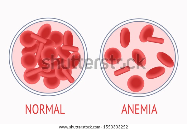 Anemia Concept Vector Isolated Color Image: เวกเตอร์สต็อก (ปลอดค่า ...