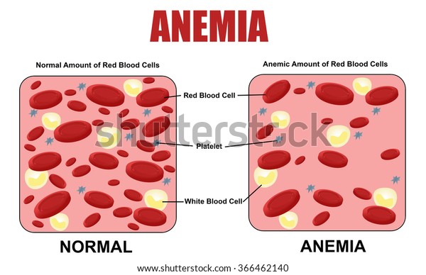 Anemia diagram, vector illustration (for basic medical education, for ...