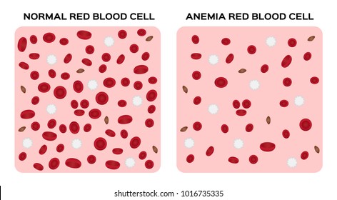 Anemia Vector Blood Anatomy Concept Stock Vector (Royalty Free ...