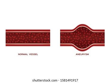 Aneurysm Blood Vessel Anatomy Vector Stock Vector (Royalty Free ...