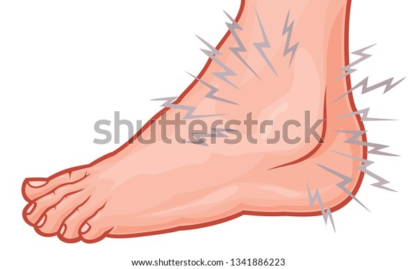 Ankle Sprain Vector Illustration Stock Vector (Royalty Free) 1341886223 ...