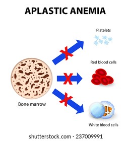 Aplastic Anemia Disease Bone Marrow Stock Vector (Royalty Free ...