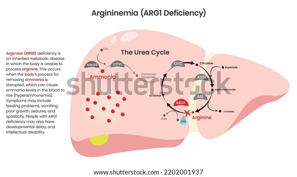 Arginase Arg1 Deficiency Vector Diagram Illustration Stock Vector ...