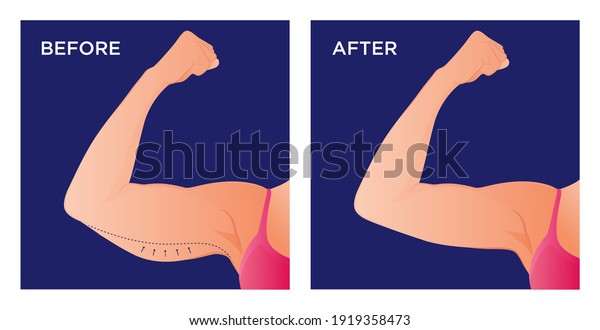 Arm with excess skin before and after surgical operation. Saggy skin ...