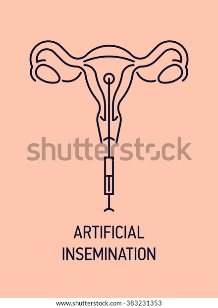Artificial Insemination flat line illustration diagram. Intrauterine ...