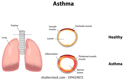 Asthma Labeled Diagram Stock Vector (Royalty Free) 199419872 | Shutterstock