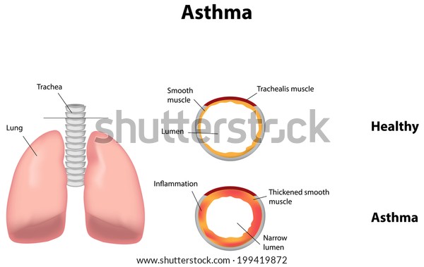 Asthma Labeled Diagram Stock Vector (Royalty Free) 199419872 | Shutterstock