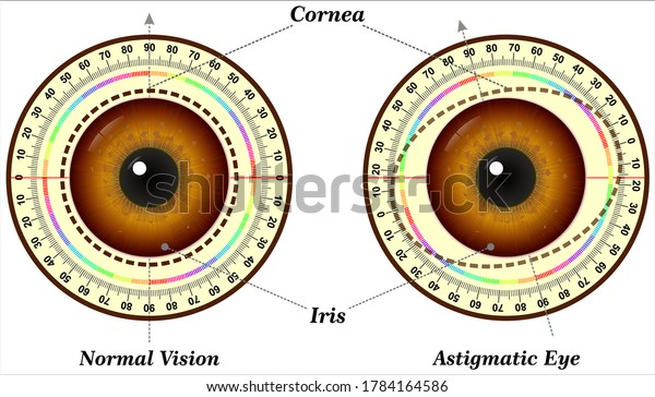 Astigmatism Common Vision Condition That Causes Stock Vector (Royalty ...