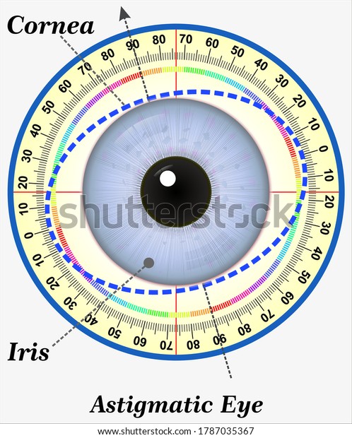 Astigmatism Common Vision Condition That Causes Stock Vector (Royalty ...
