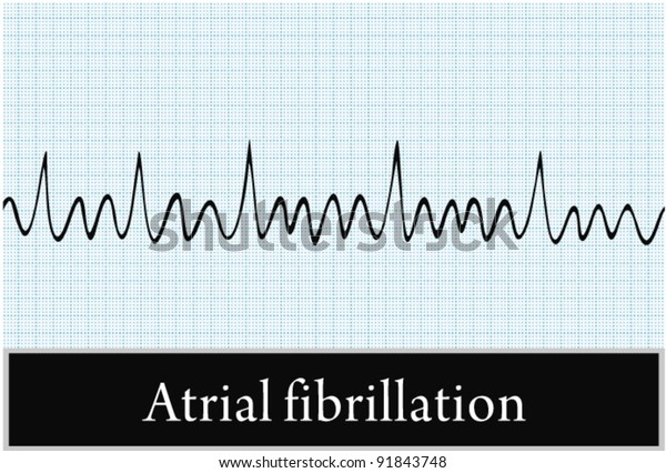 Atrial Fibrillation Vector Professional Information Stock Vector ...