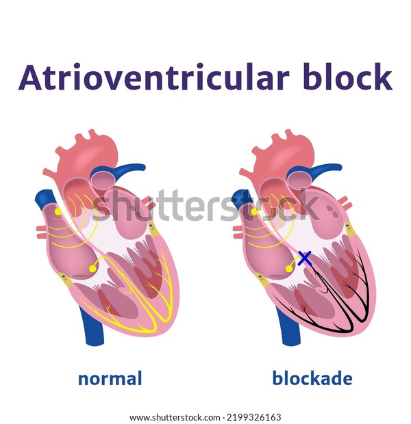 Atrioventricular Block Violation Electrical Signal Heart Stock Vector ...