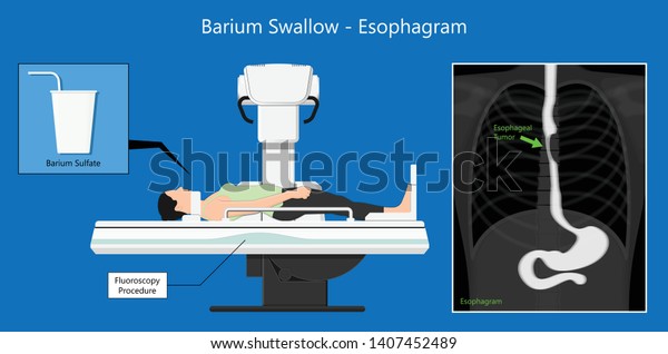 Barium Swallow Study Test Diagnose Barretts Stock Vector (Royalty Free ...