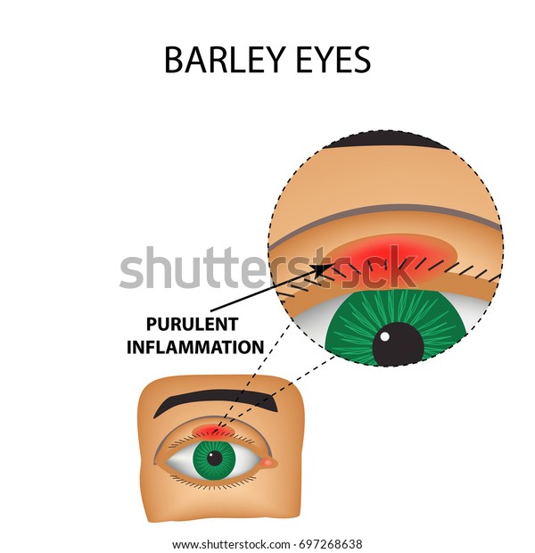 Barley Eyes Purulent Inflammation Structure Eye Stock Vector (Royalty ...