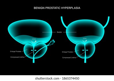 Benign Prostatic Hyperplasia Logo Clinic Normal Stock Vector (Royalty ...