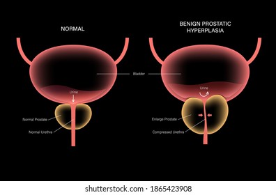 Benign Prostatic Hyperplasia Logo Clinic Normal Stock Vector (Royalty ...