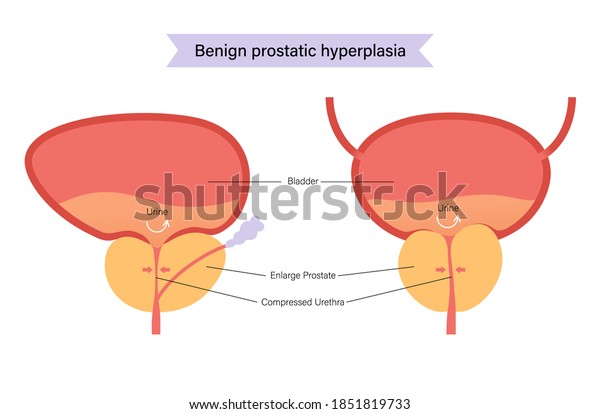 Benign prostatic hyperplasia logo for clinic. Normal bladder and BPH ...