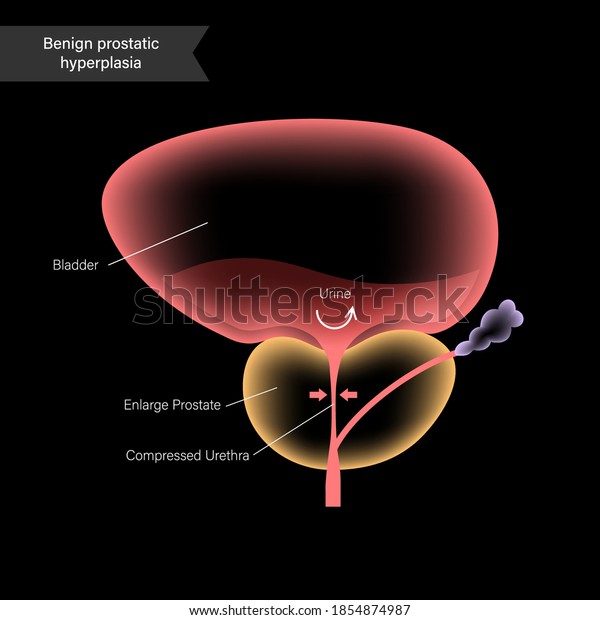 Benign Prostatic Hyperplasia Logo Clinic Bph Stock Vector (Royalty Free ...