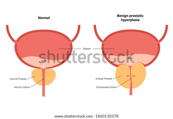 Benign prostatic hyperplasia logo for clinic. Normal bladder and BPH ...