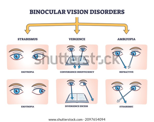 33 Convergent strabismus 이미지, 스톡 사진 및 벡터 | Shutterstock