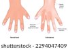 2+ Thousand Scleroderma Royalty-Free Images, Stock Photos & Pictures ...