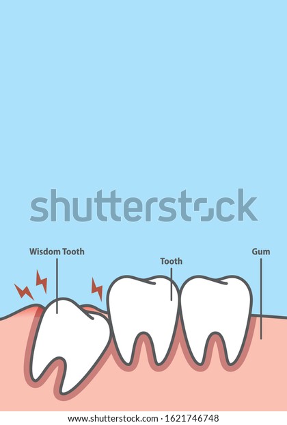 Blank Banner Impacted Tooth Inside Under Stock Vector (Royalty Free ...