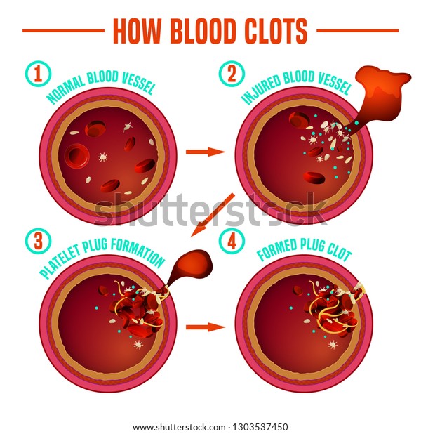 Blood Clotting Process Vessel Cut Medical Stock Vector (Royalty Free ...