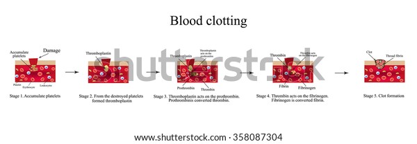 Blood Clotting Stage Clotting Infographics Vector Stock Vector (Royalty ...