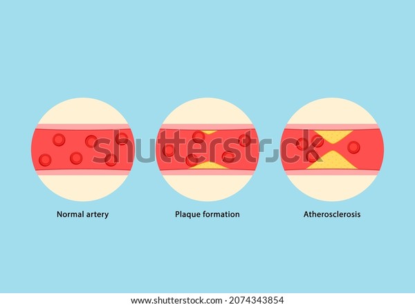 Blood Vessel Atherosclerosis Infographics Tiny Medic Stock Vector ...